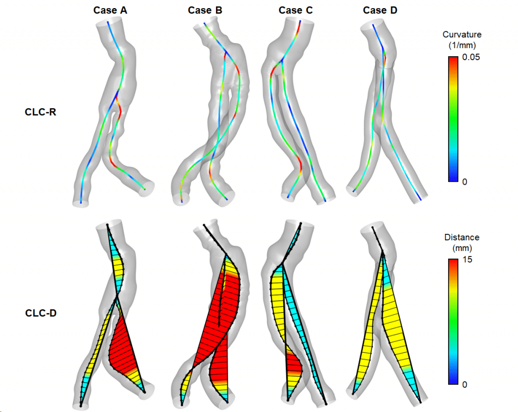 The effect of stent graft curvature on the hemodynamic displacement ...