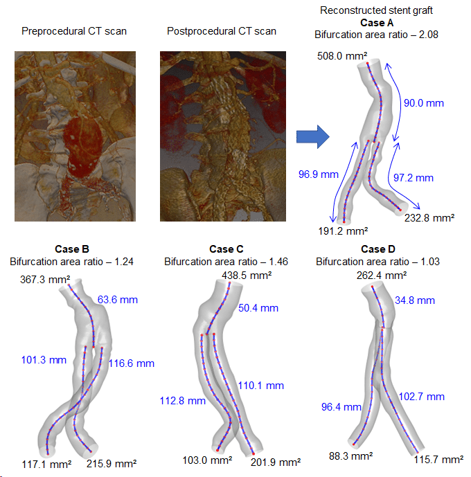 The effect of stent graft curvature on the hemodynamic displacement ...