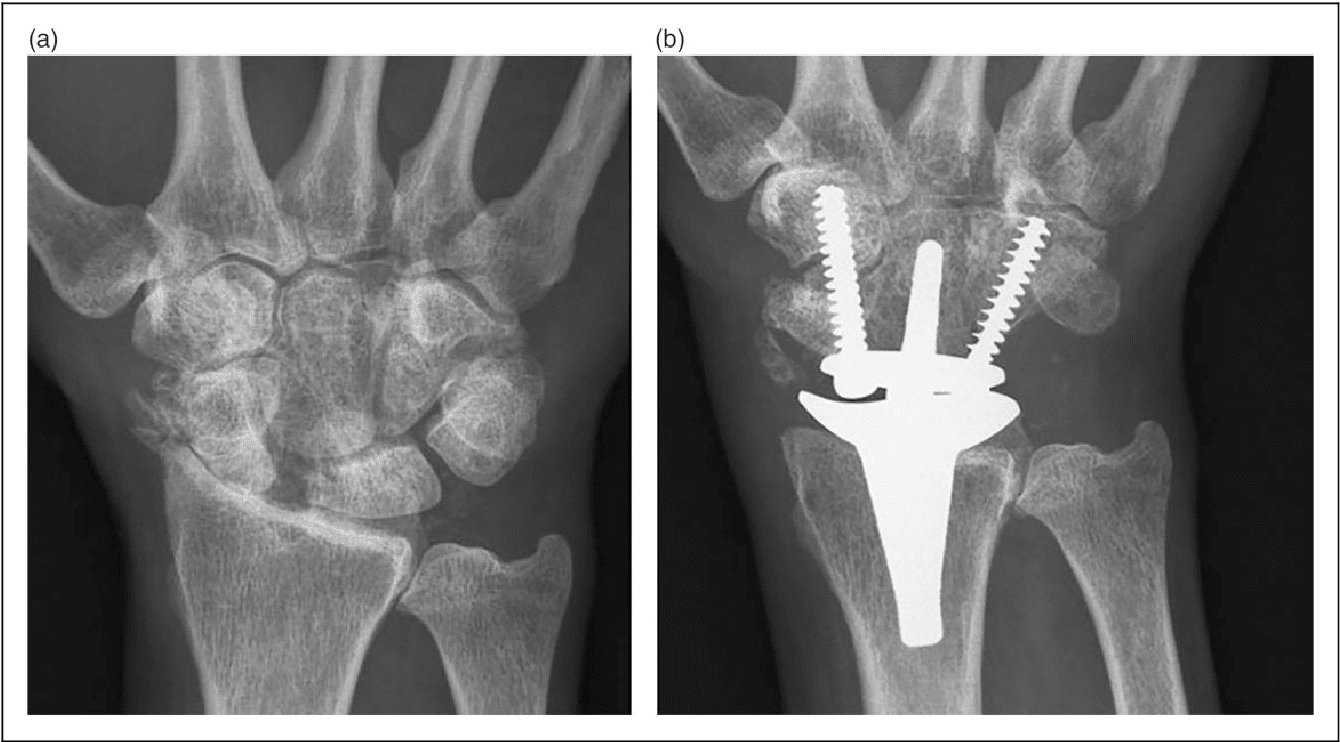 The Mechanical Interaction of the Wrist Joint During Typical Motion ...
