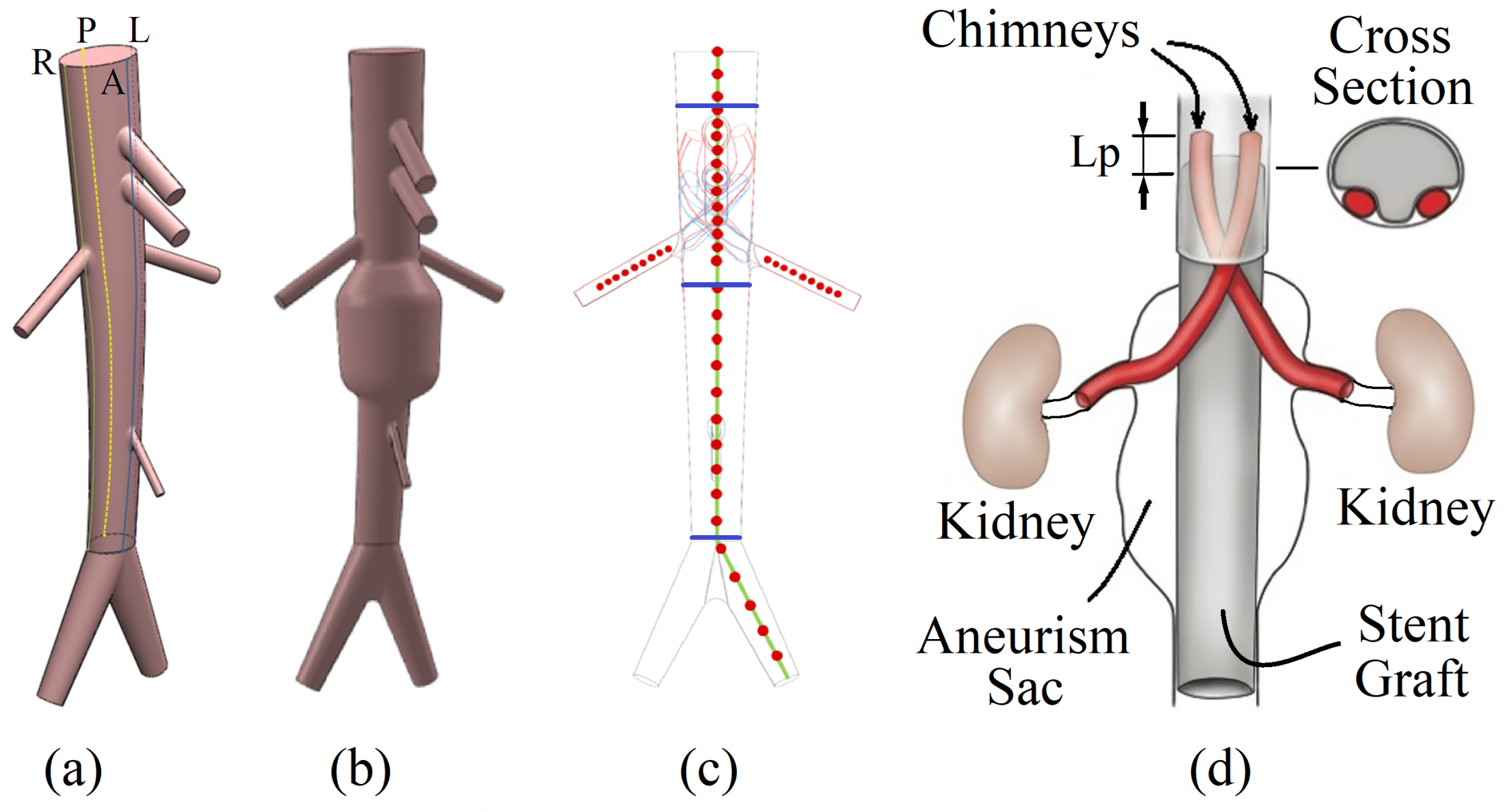Chimney endovascular aneurysm repair with different configurations ...